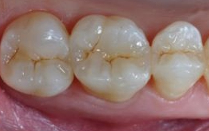 Style Italiano Advanced: The Complete Composite Course | Dental ED